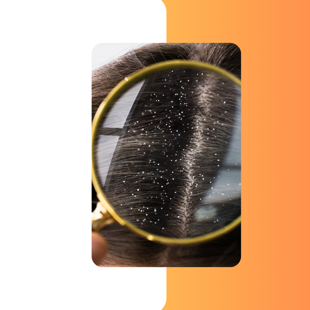 Dandruff Treatments